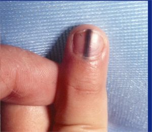 You Should Never Ignore These 9 Things Your Fingernails Reveal About ...