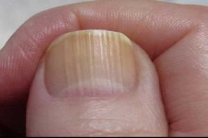You Should Never Ignore These 9 Things Your Fingernails Reveal About ...