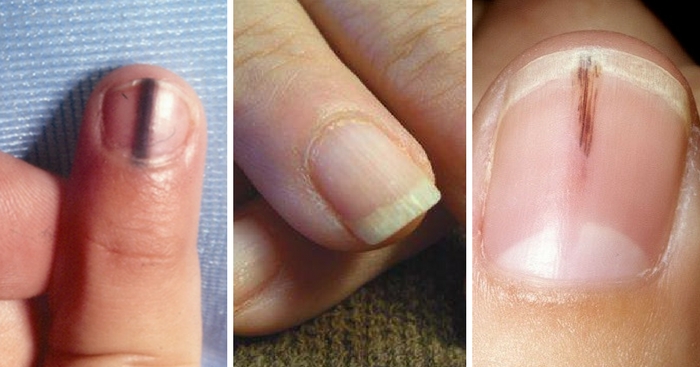 You Should Never Ignore These 9 Things Your Fingernails Reveal About you-should-never-ignore-these-9-things-your-fingernails-reveal-about