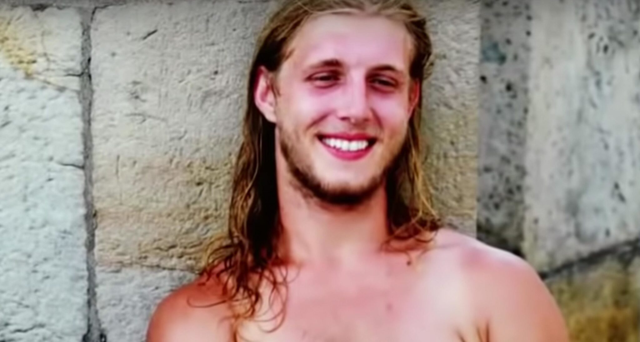 Patrick Hardison Received A New Face After Third-degree Burns, This Is ...