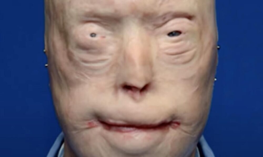 Patrick Hardison Received A New Face After Third-degree Burns, This Is ...