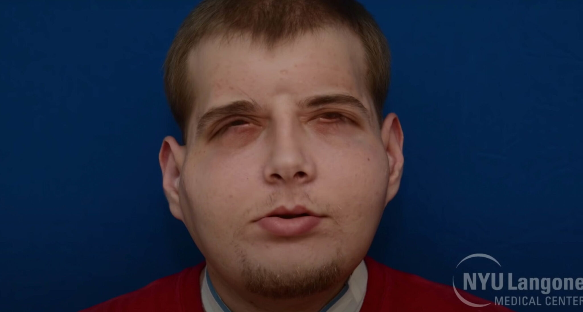 Patrick Hardison Received A New Face After Third-degree Burns, This Is ...