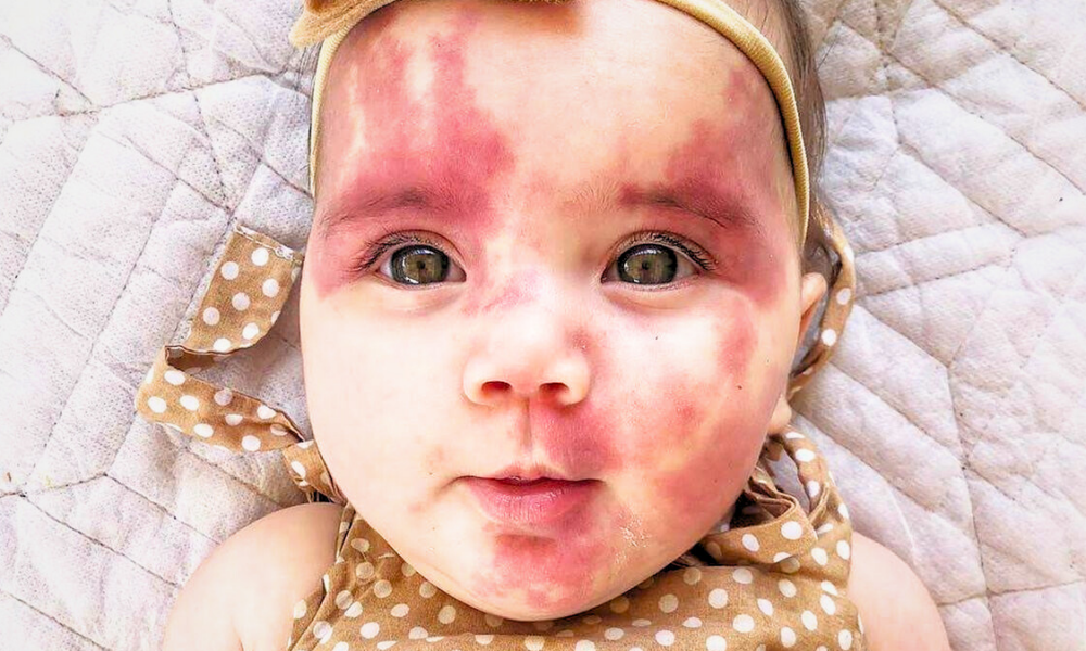 Baby With Red Birthmark Called 'Hideous' And 'Defective', But Wait Till ...