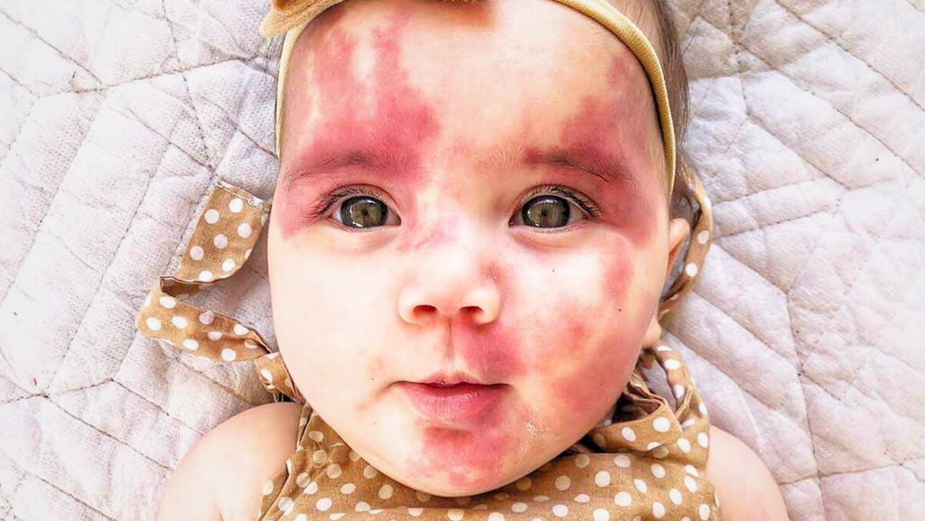 Baby With Red Birthmark Called 'Hideous' And 'Defective', But Wait Till ...