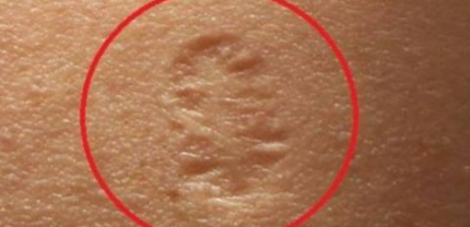 Do You Know The Real Significance Of The Small Scar On The Upper Left Arm
