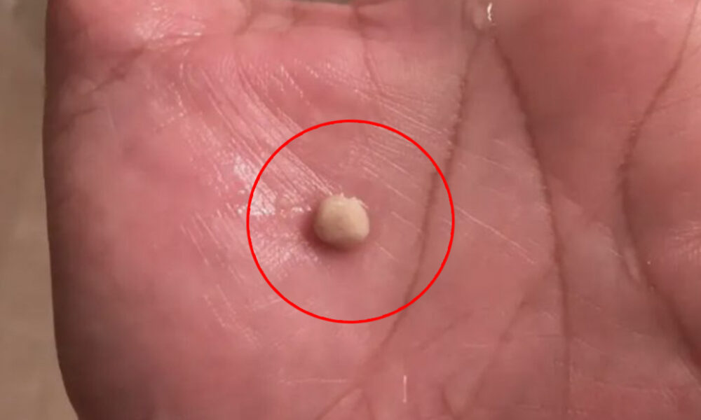 Here’s What You Need To Know About Tonsil Stones – The Weird Pimple ...