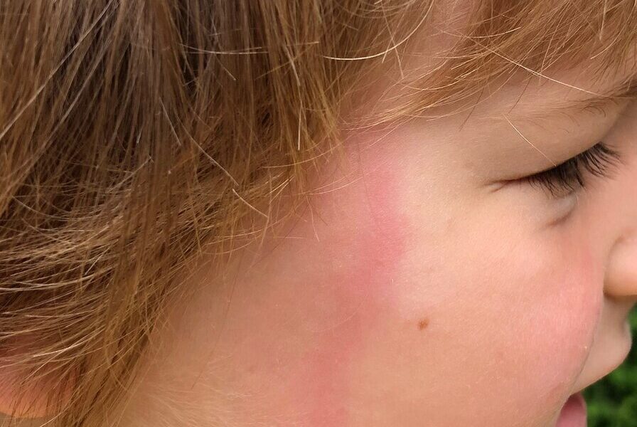 Here's Why Parents Should Look Out for Red Tracking Lines on Their Kids ...