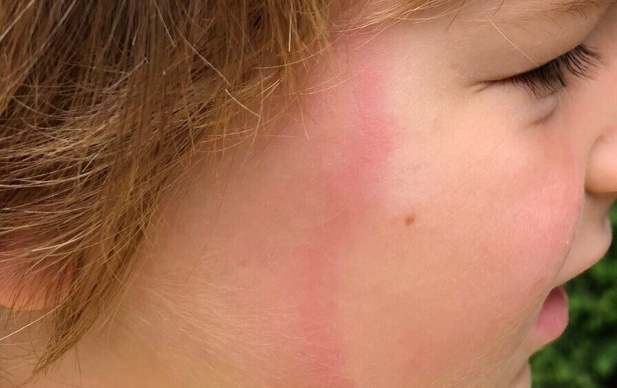 Here's Why Parents Should Look Out for Red Tracking Lines on Their Kids ...