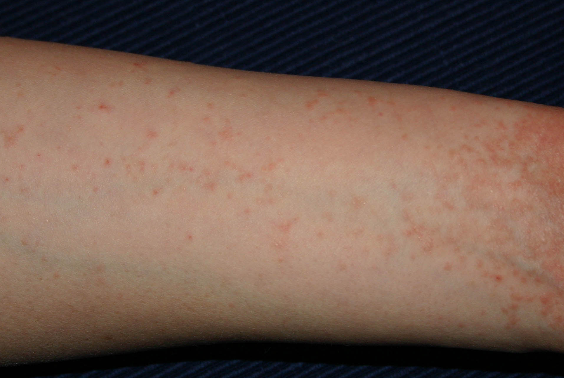 If You Have These Tiny Red Dots On Your Arm, Do Not Ignore The Warning ...