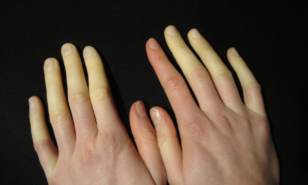 Your Fingertips May Change Color During The Chilly Winter Months Due To ...