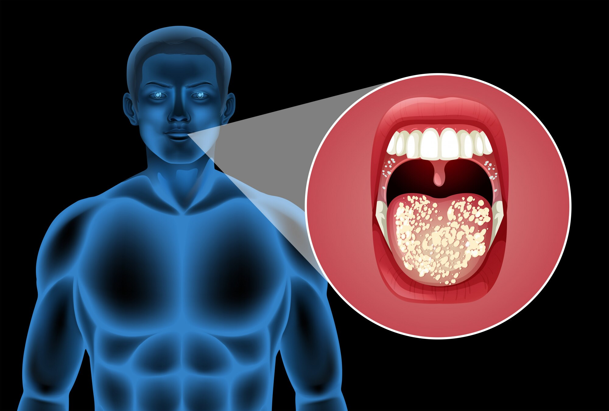 Signs Of Oral Cancer Stage By Stage You Don't Want To Miss