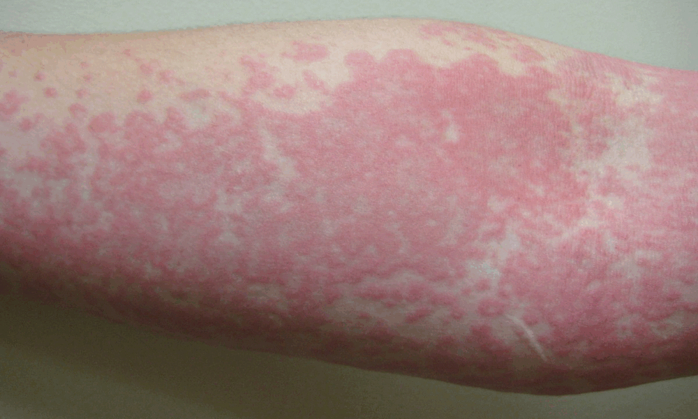 Surprising Causes Of Hives Revealed