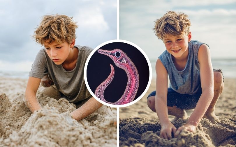 Florida Teen Develops Painful Hookworm Infection After Sand Burial